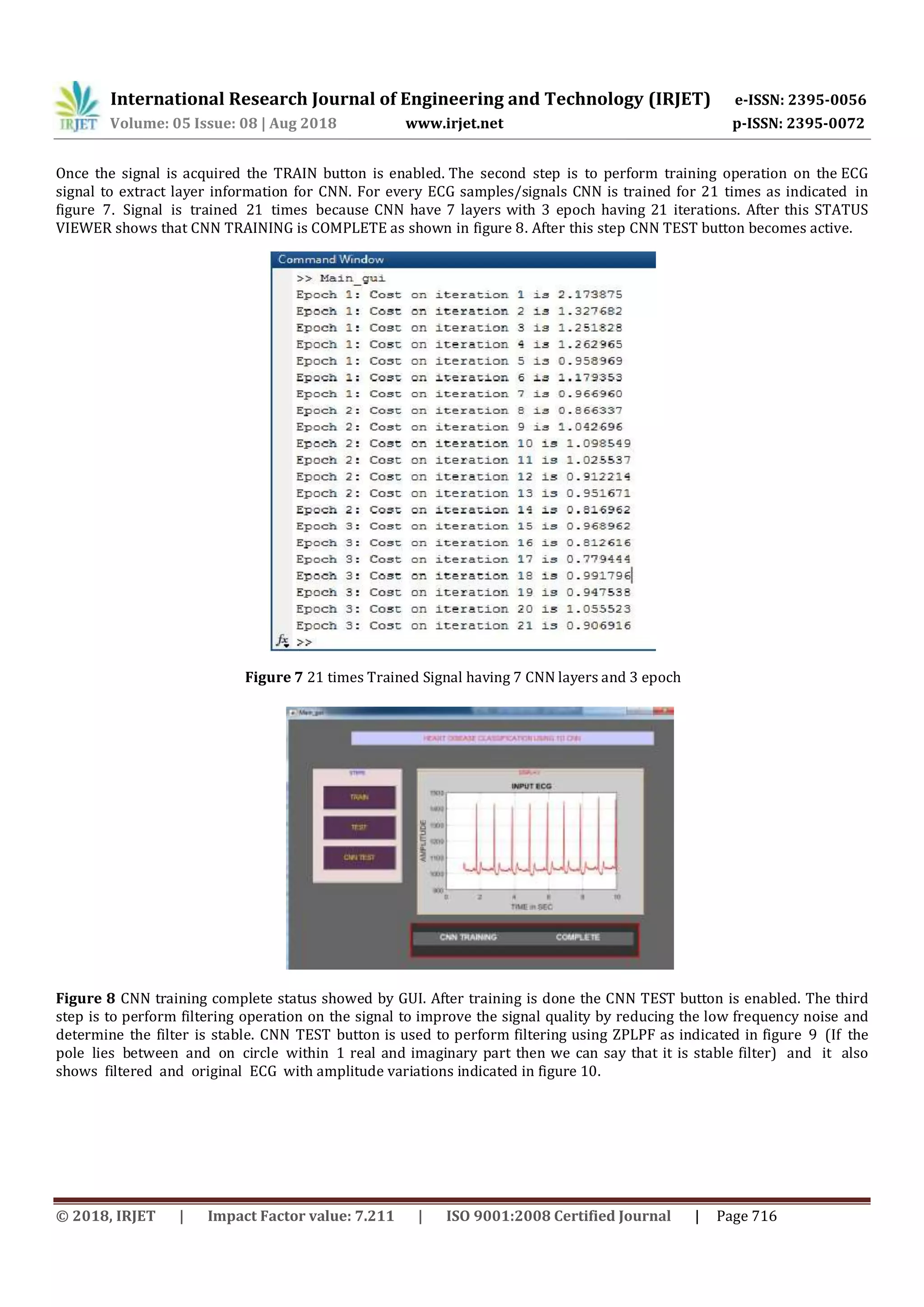 Irjet Arrhythmia Detection Using One Dimensional Convolutional Neural