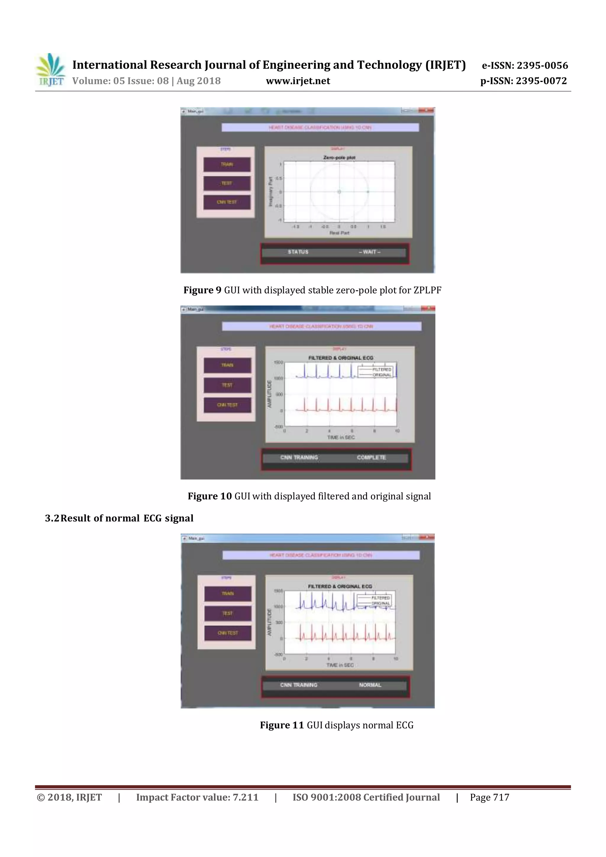 IRJET- Arrhythmia Detection using One Dimensional Convolutional Neural Network | PDF