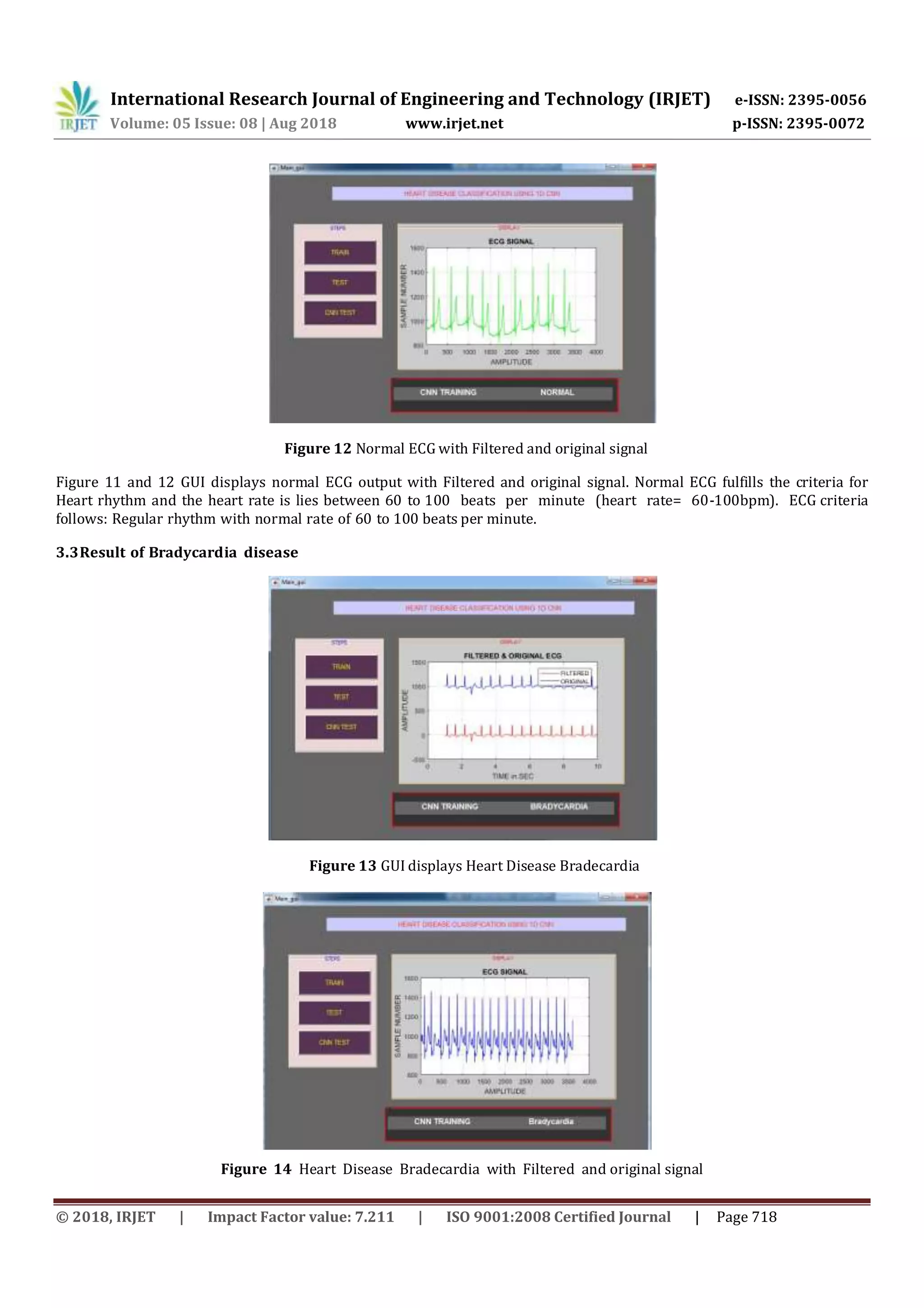 IRJET- Arrhythmia Detection using One Dimensional Convolutional Neural Network | PDF
