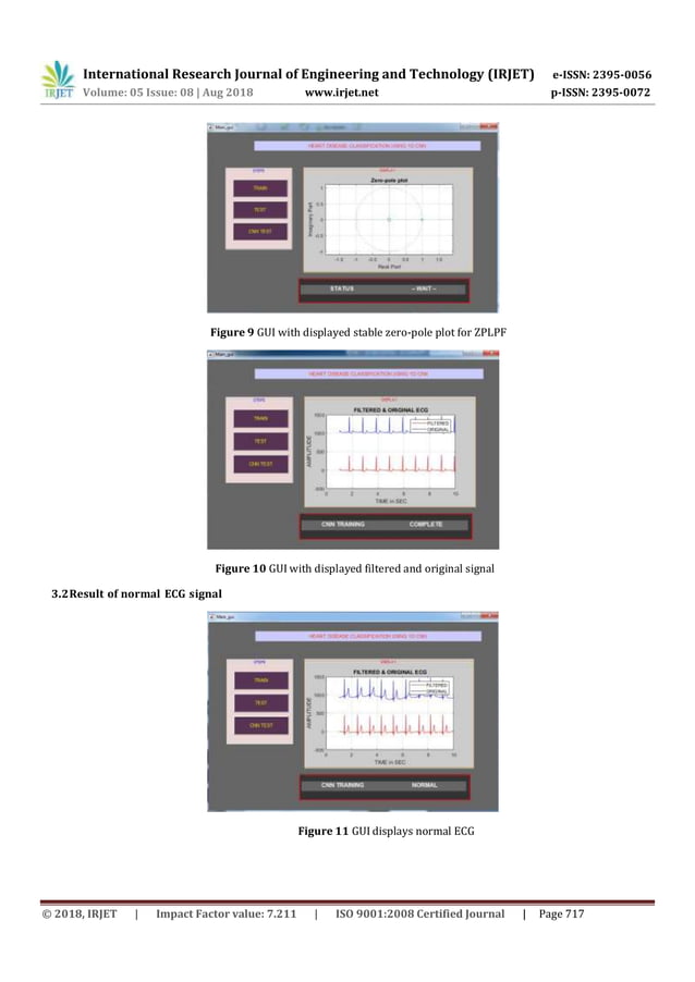 IRJET- Arrhythmia Detection using One Dimensional Convolutional Neural Network | PDF