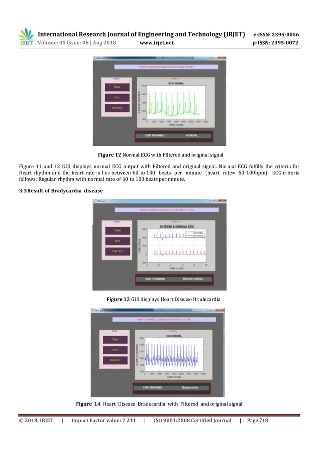 IRJET- Arrhythmia Detection using One Dimensional Convolutional Neural Network | PDF