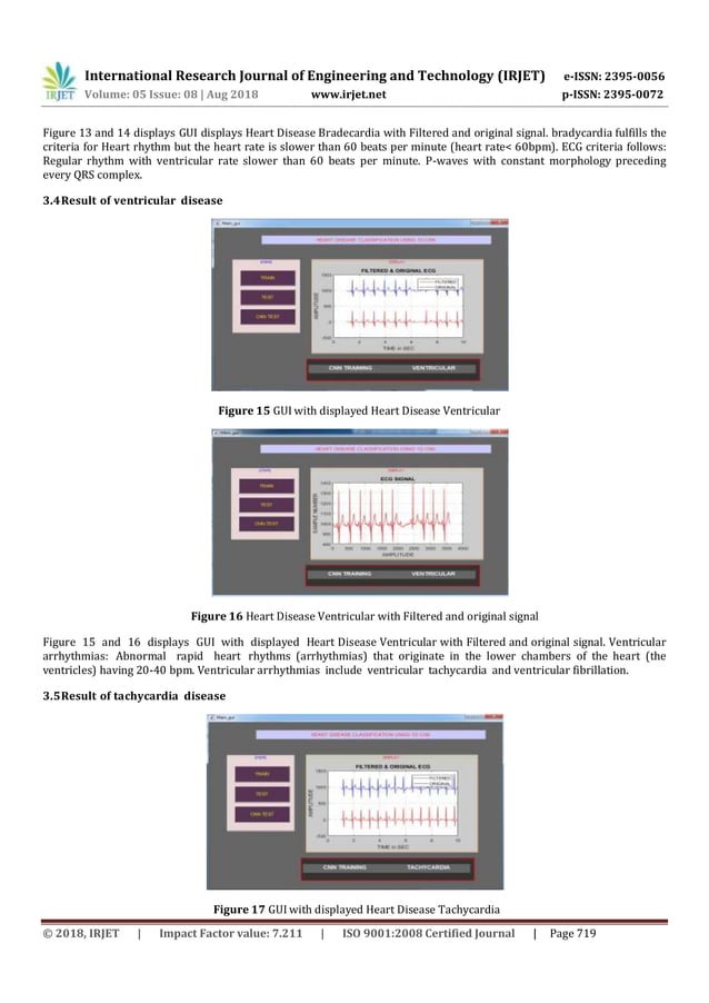 IRJET- Arrhythmia Detection using One Dimensional Convolutional Neural ...