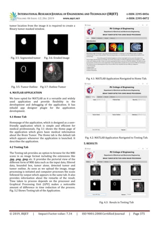 IRJET- Brain Tumor Detection using Image Processing and MATLAB ...