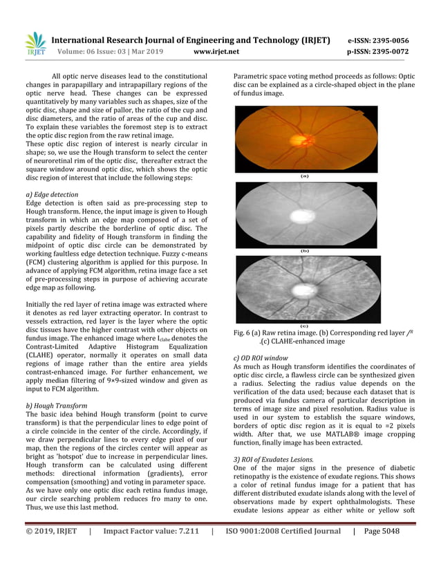 IRJET- Retinal Structure Segmentation using Adaptive Fuzzy Thresholding | PDF