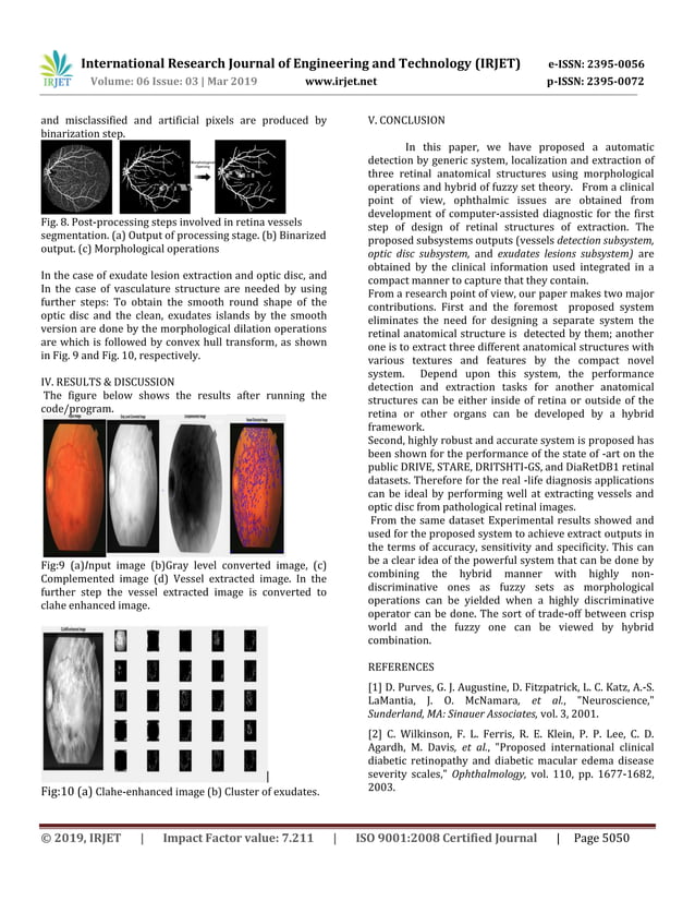 IRJET- Retinal Structure Segmentation using Adaptive Fuzzy Thresholding | PDF