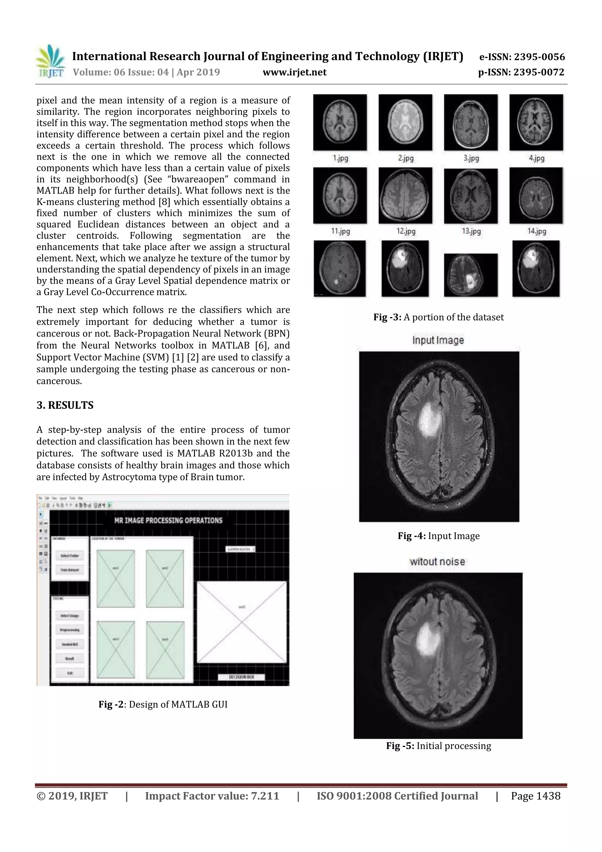 Irjet Mri Image Processing Operations For Brain Tumor Detection Pdf