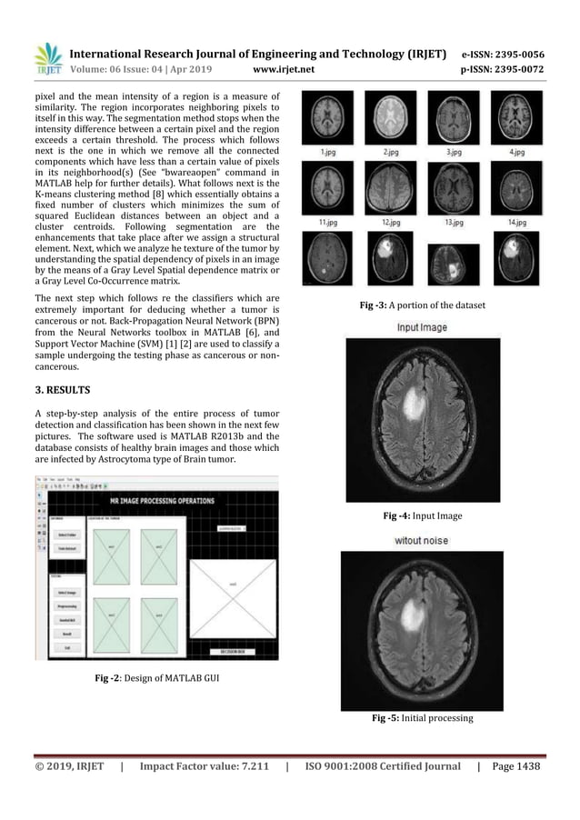 IRJET- MRI Image Processing Operations for Brain Tumor Detection | PDF | Photo Editing Software ...