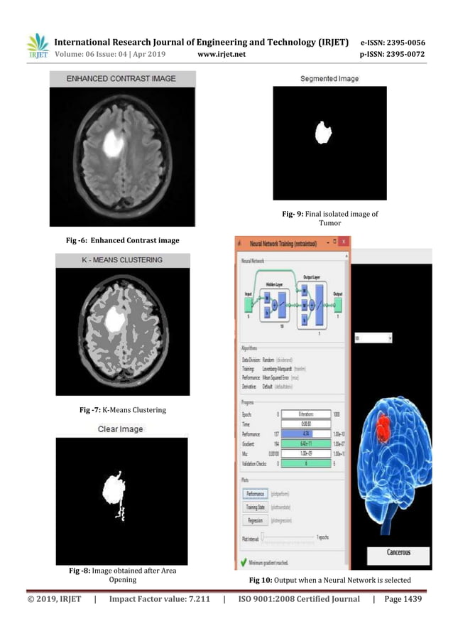 IRJET- MRI Image Processing Operations for Brain Tumor Detection | PDF | Photo Editing Software ...