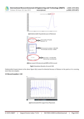 IRJET- R–Peak Detection of ECG Signal using Thresholding Method | PDF