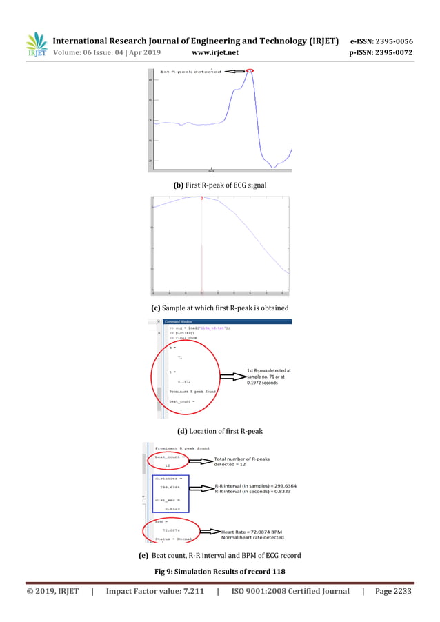 Irjet R Peak Detection Of Ecg Signal Using Thresholding Method Pdf