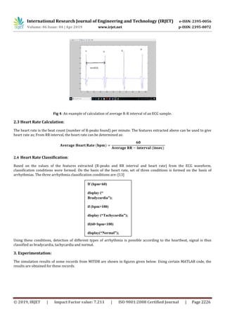 IRJET- R–Peak Detection of ECG Signal using Thresholding Method | PDF