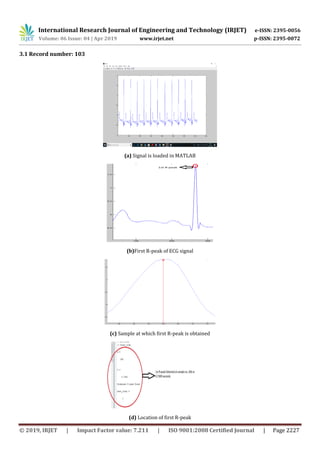 IRJET- R–Peak Detection of ECG Signal using Thresholding Method | PDF