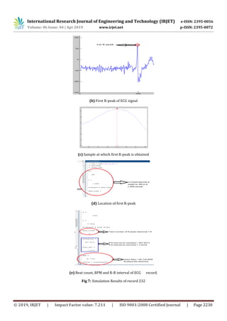 IRJET- R–Peak Detection of ECG Signal using Thresholding Method | PDF