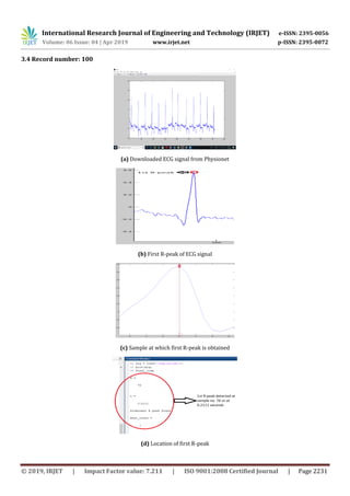 IRJET- R–Peak Detection of ECG Signal using Thresholding Method | PDF