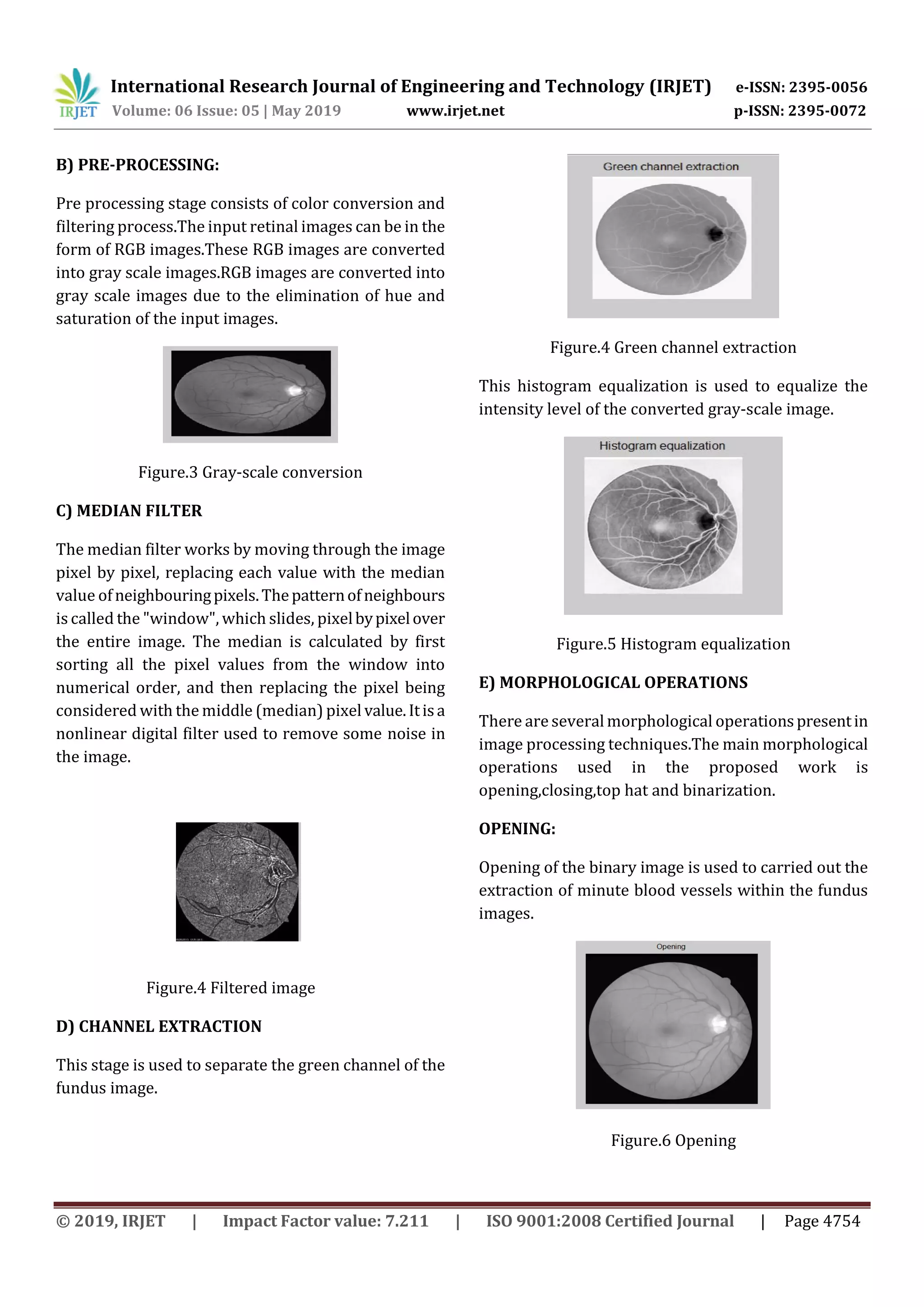 IRJET- Automated Detection of Diabetic Retinopathy using Compressed Sensing | PDF