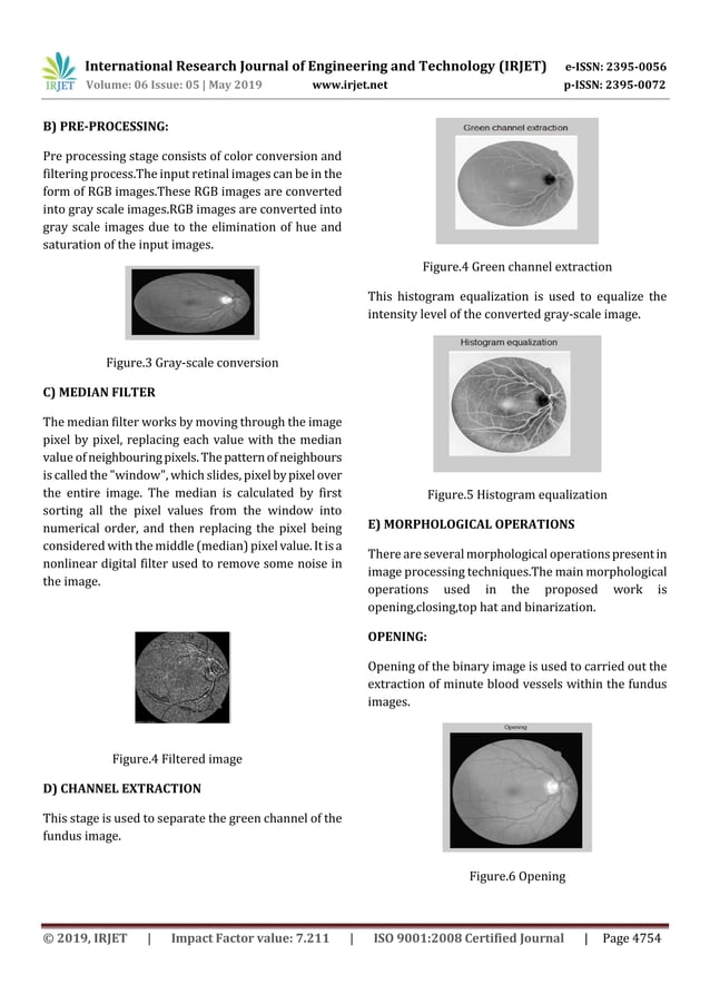 IRJET- Automated Detection of Diabetic Retinopathy using Compressed Sensing | PDF