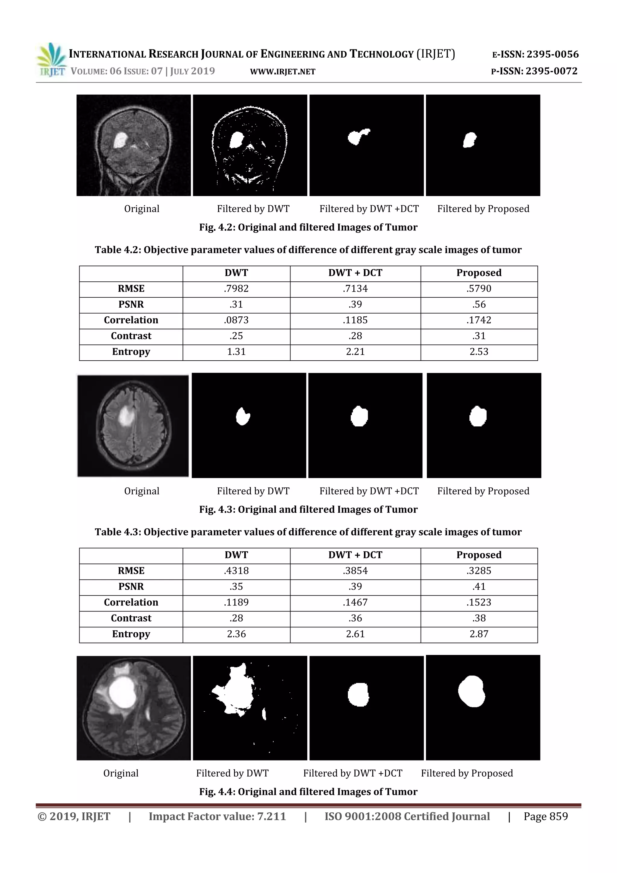 IRJET- Brain Tumor Detection using Hybrid Model of DCT DWT and Thresholding | PDF