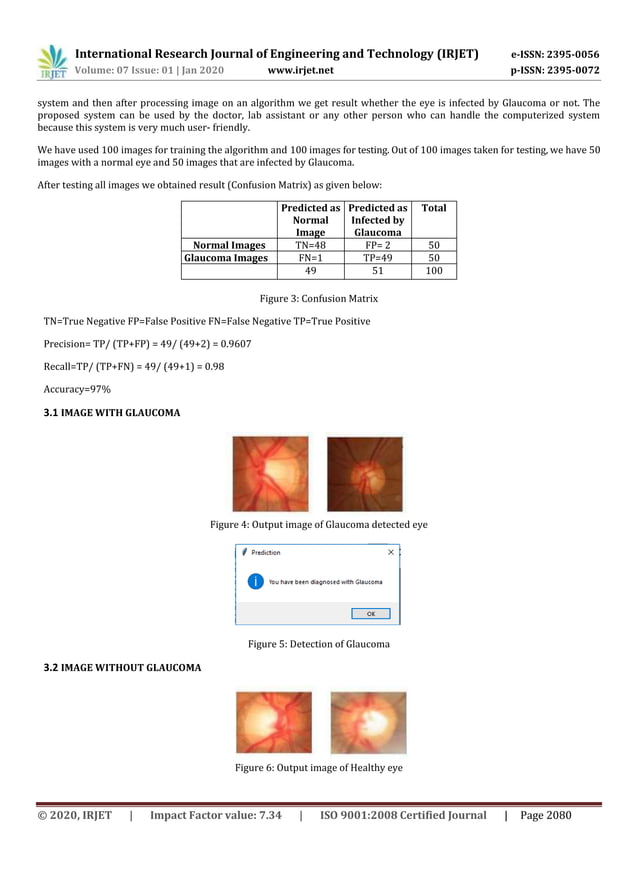 Irjet Glaucoma Detection Using Convolutional Neural Network Pdf