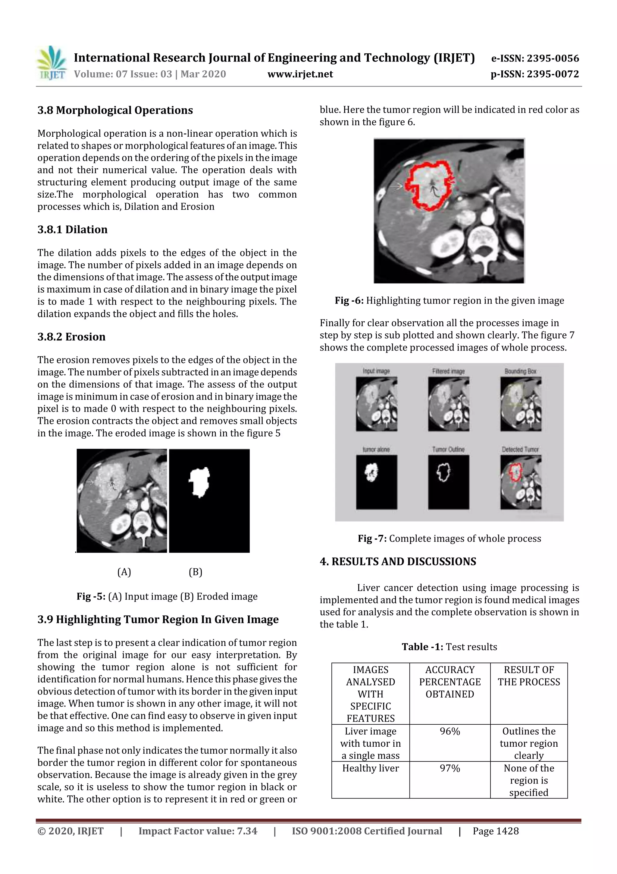 IRJET - Liver Cancer Detection using Image Processing | PDF