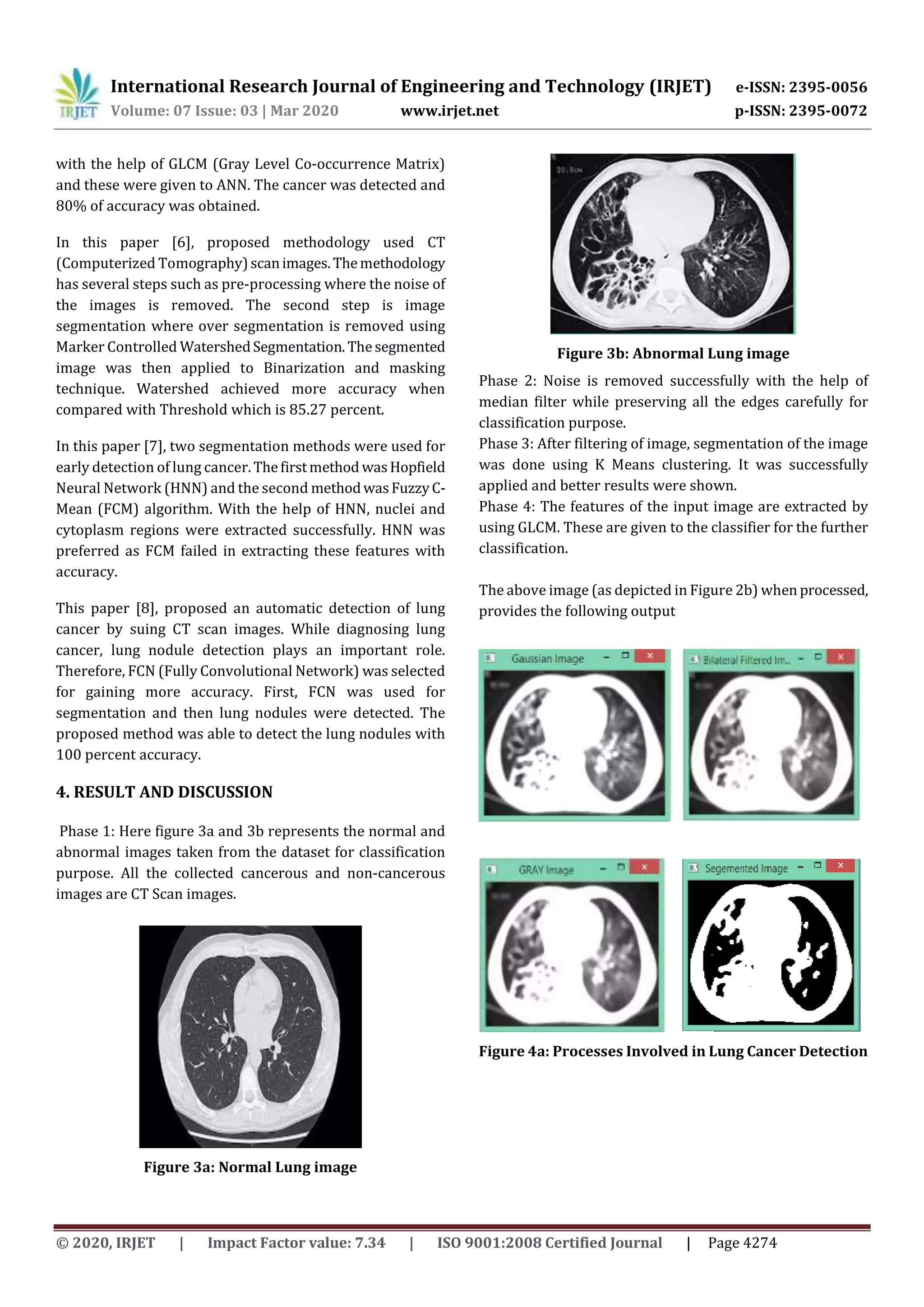 Irjet Lung Cancer Detection Using Glcm And Convolutional Neural Network Pdf