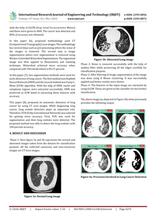 IRJET - Lung Cancer Detection using GLCM and Convolutional Neural ...