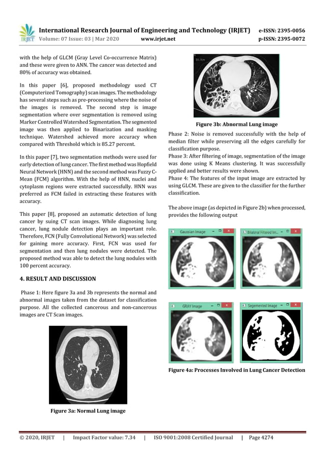 IRJET - Lung Cancer Detection using GLCM and Convolutional Neural ...