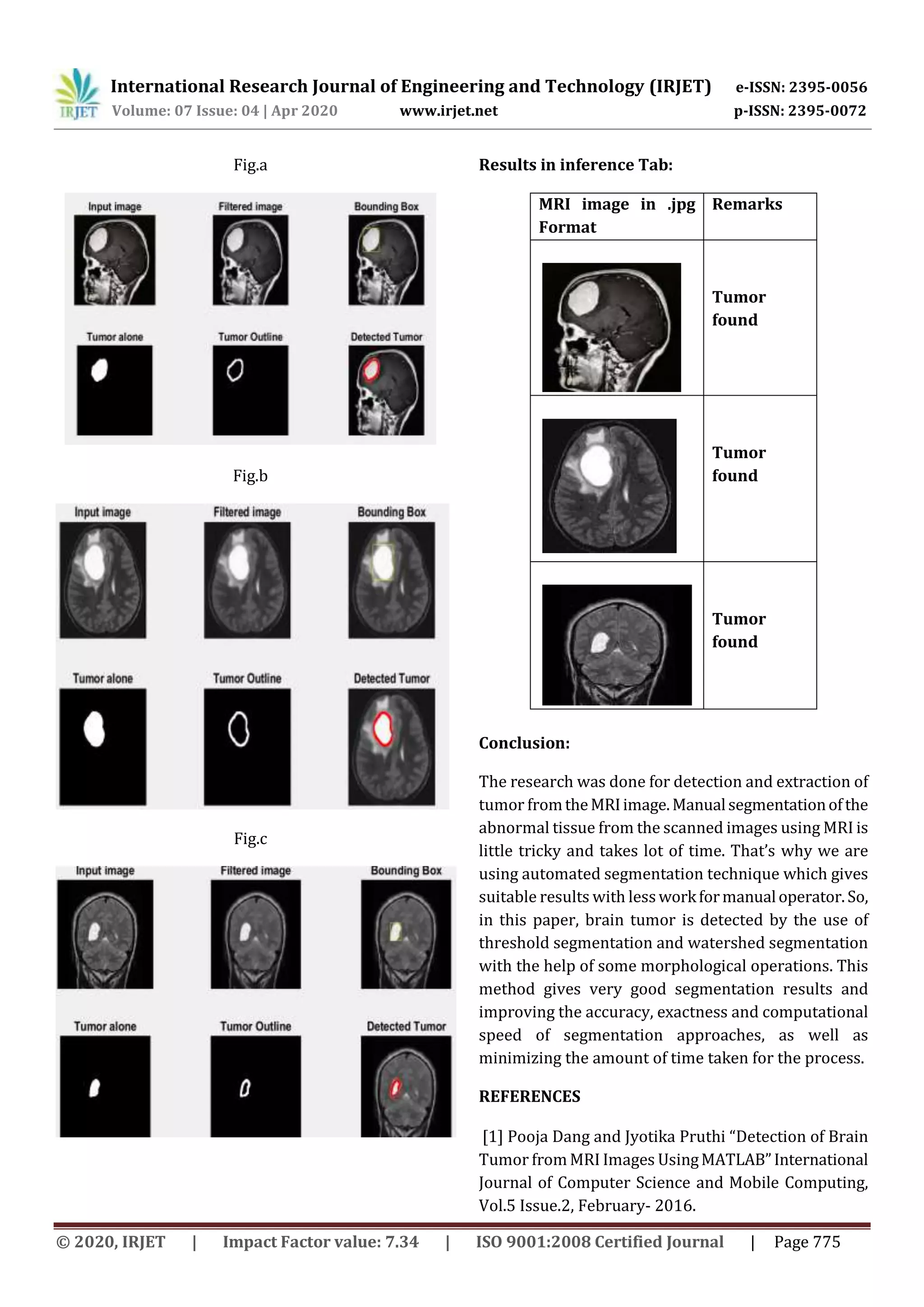 Irjet Detection Of Brain Tumor From Mri Images Using Matlab Pdf