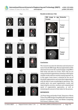 IRJET - Detection of Brain Tumor from MRI Images using MATLAB | PDF