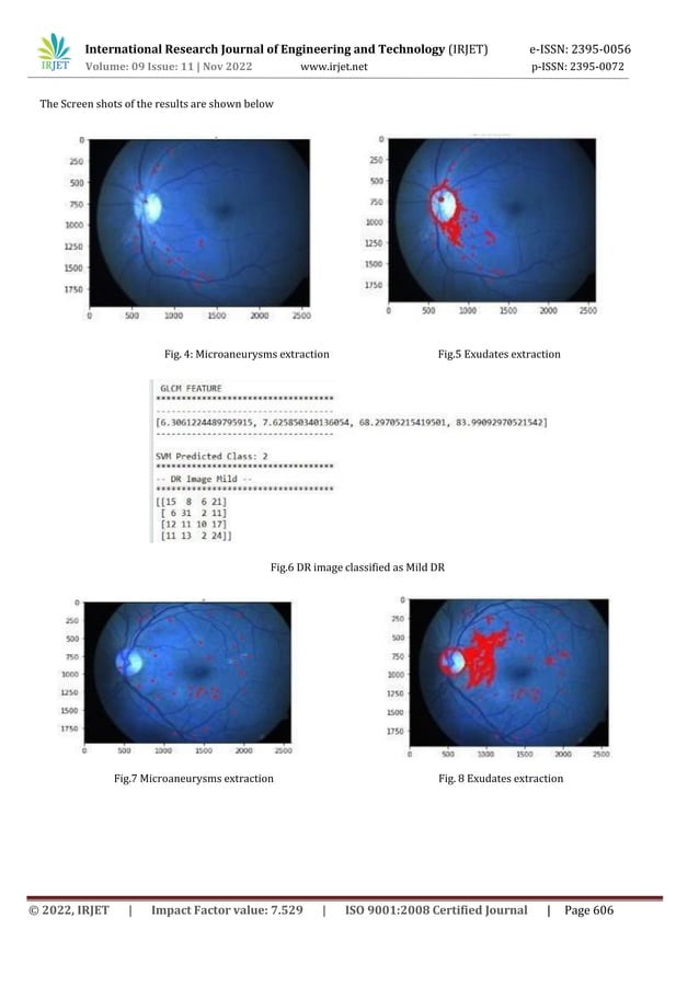 FEATURE EXTRACTION TO DETECT AND CLASSIFY DIABETIC RETINOPATHY USING FUNDAL IMAGES | PDF
