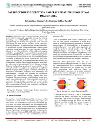 CATARACT DISEASE DETECTION AND CLASSIFICATION USING RETINAL IMAGE MODEL | PDF