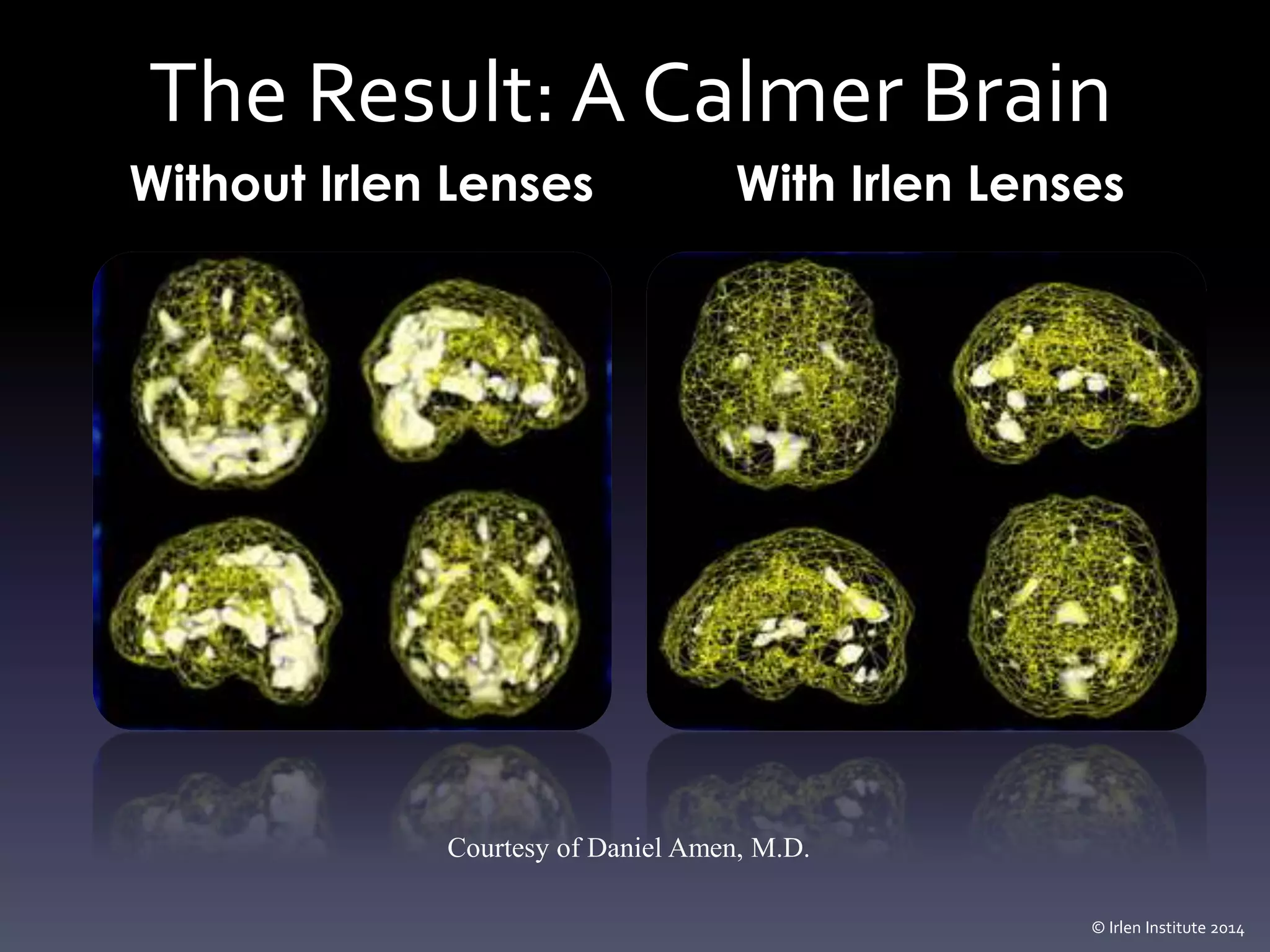 Irlen syndrome & irlen method overview & case study | PPTX