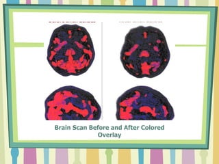 Irlen syndrome & the irlen method | PPTX