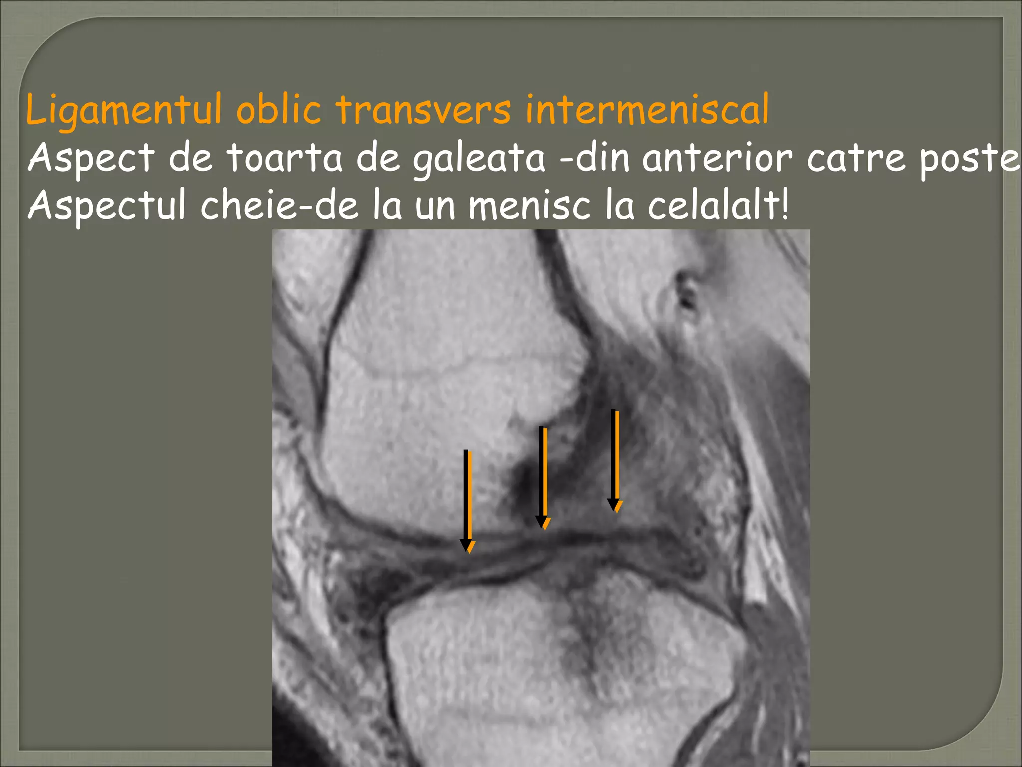 IRM a meniscurilor.ppt