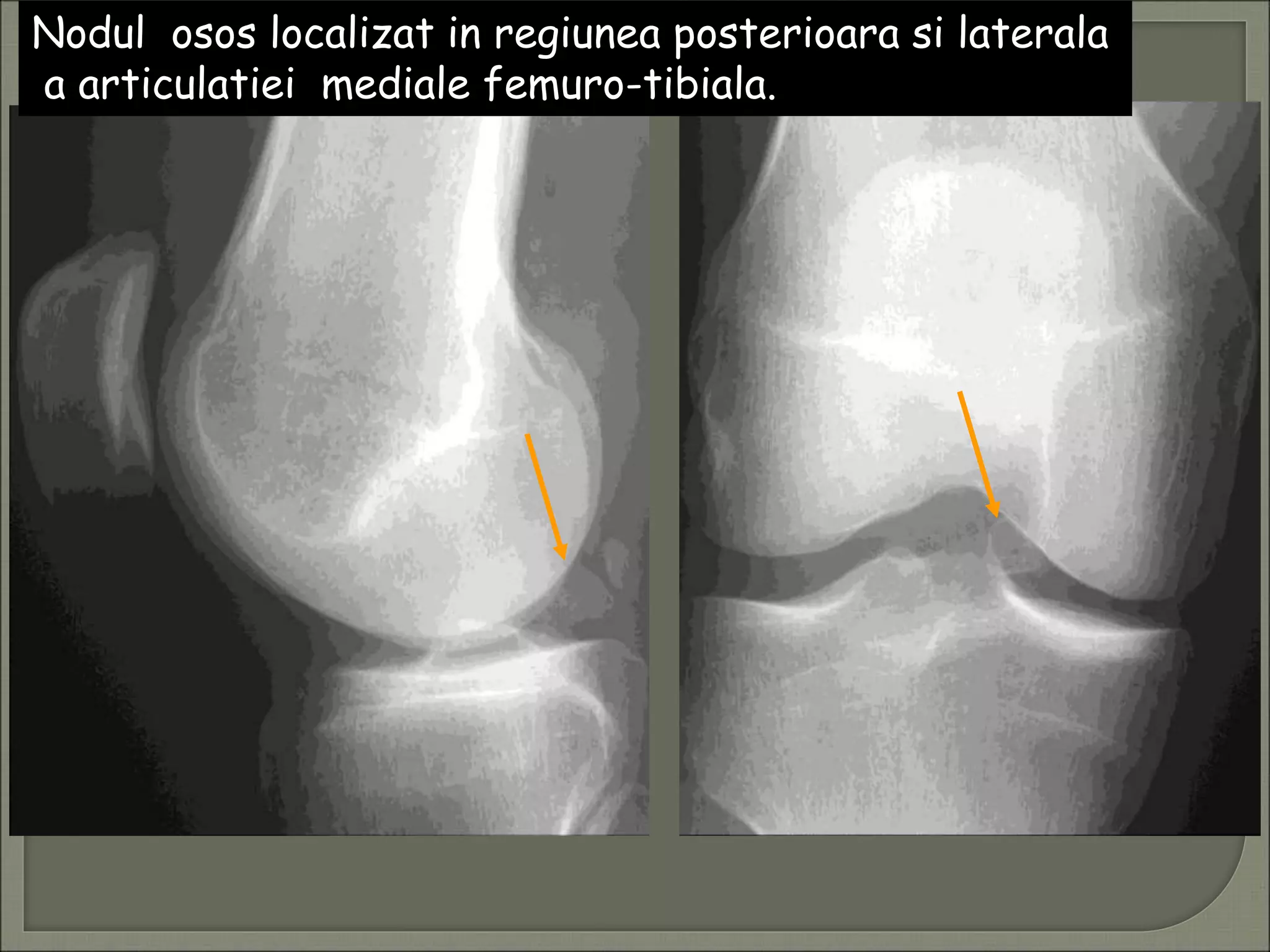IRM a meniscurilor.ppt