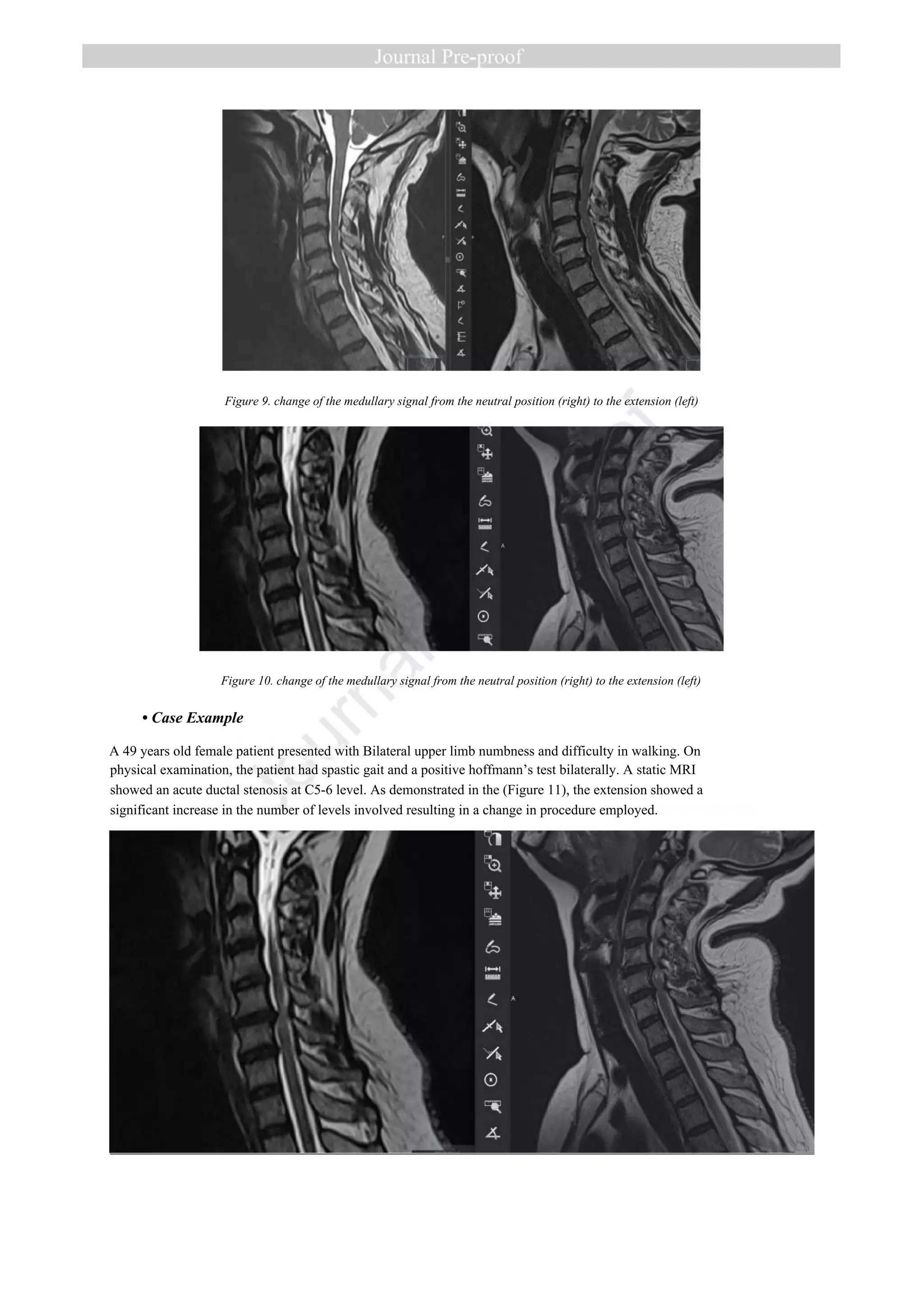 The value of dynamic MRI in cervical spondylotic myelopathy: About 24 ...
