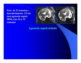 Irm Fetal Neonatologos | PDF