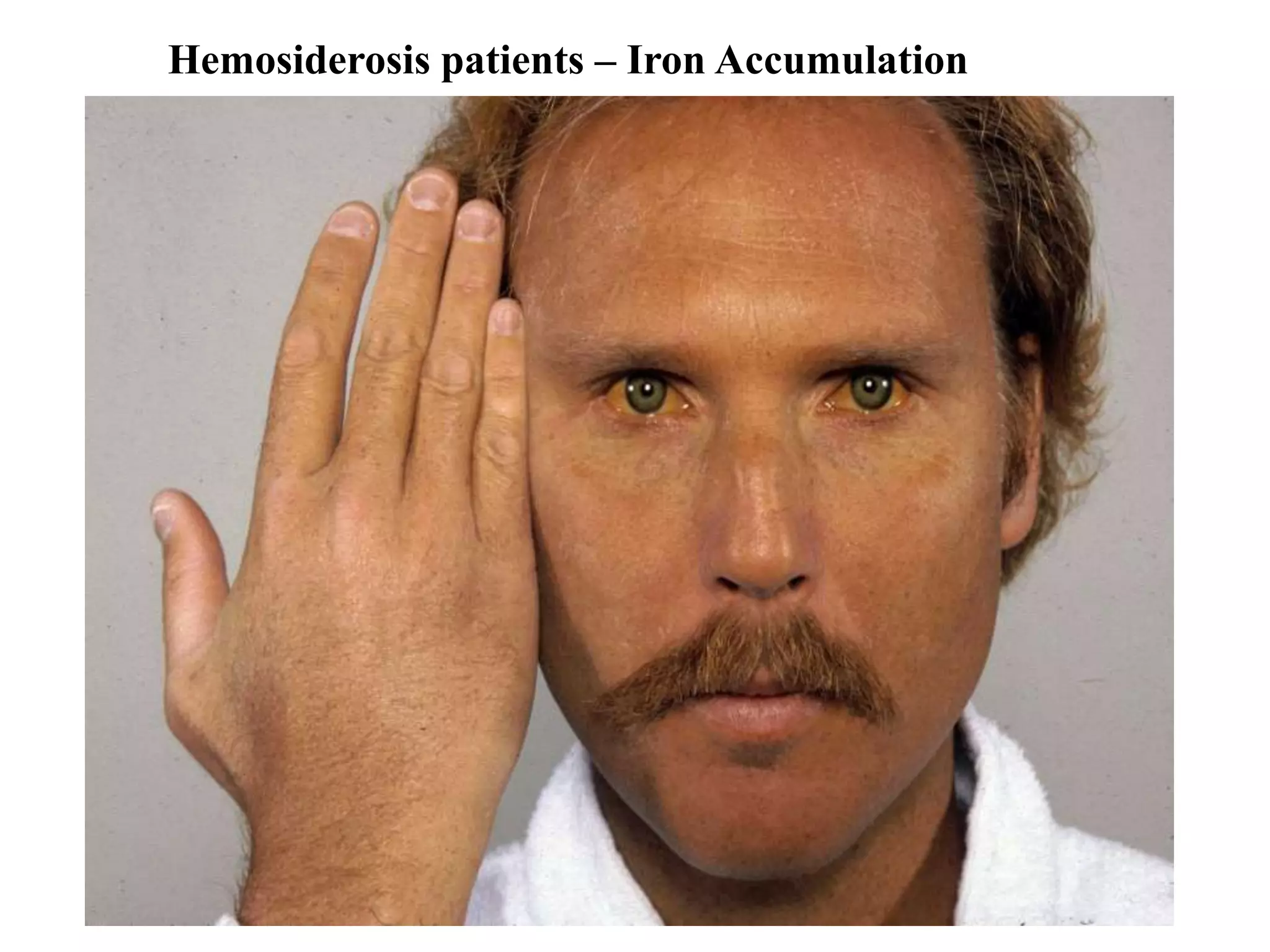 Iron biochemical role, rda and deficiency bic 105 | PPTX