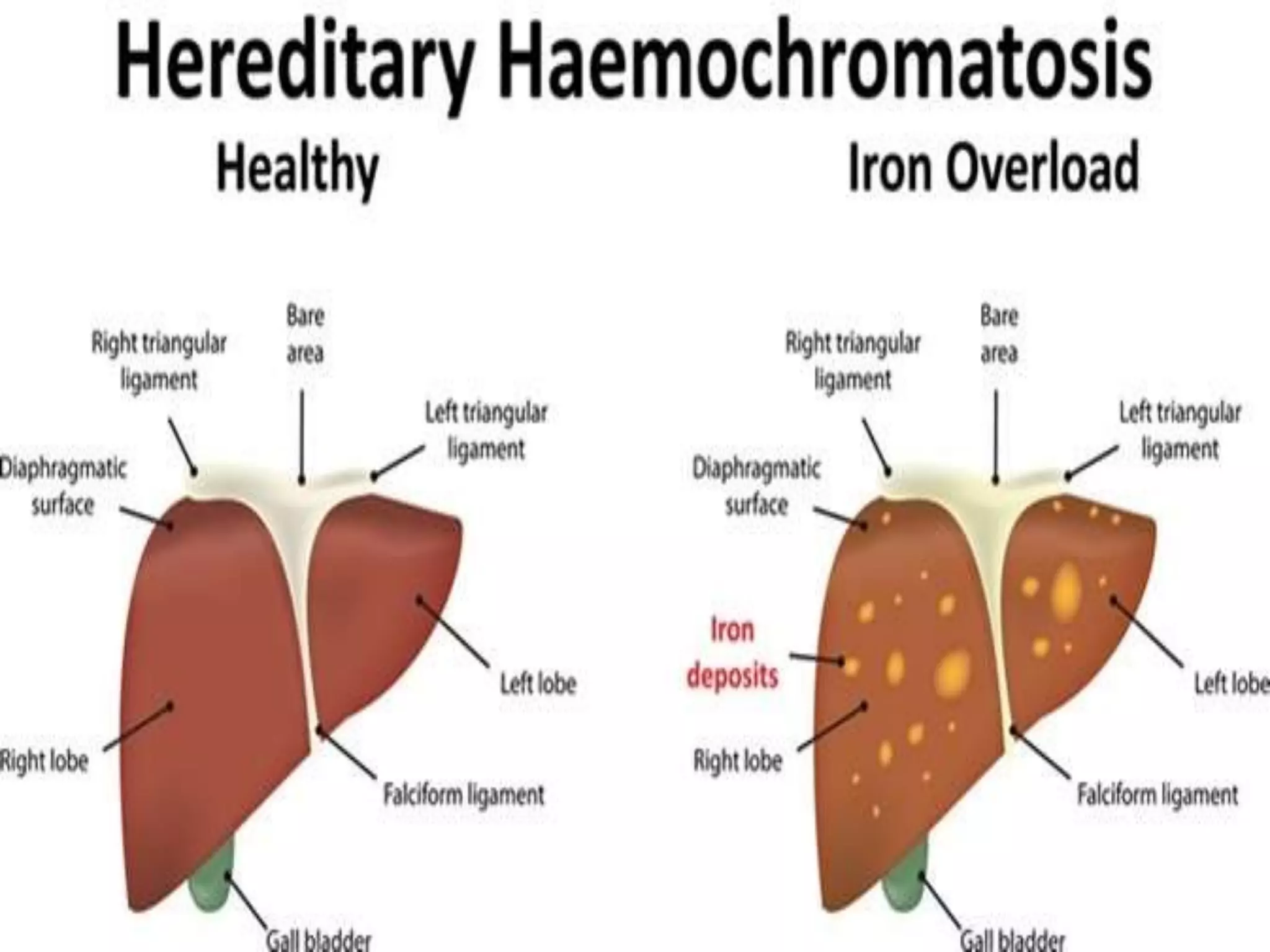 Iron biochemical role, rda and deficiency bic 105 | PPTX