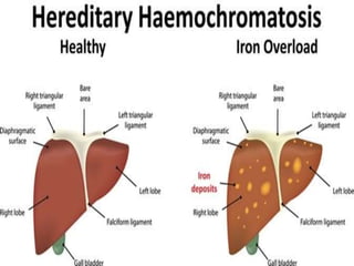 Iron biochemical role, rda and deficiency bic 105 | PPTX | Blood ...