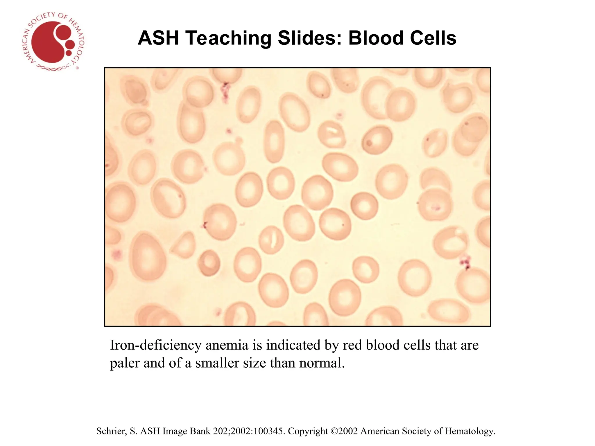 Iron - Deficiency Anemia. presentation | PPT