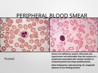 Iron Deficiency Anemia in children: The basic facts | PPT