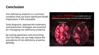 Iron Deficiency Anaemia.pptxhshhshjdjjjj | PPTX