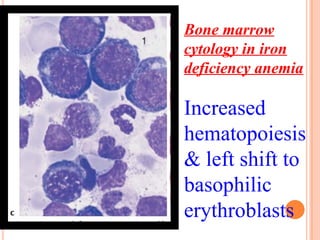 IRON DEFICIENCY ANAEMIA, P/S, S/S, DIAGNOSIS, TREATMENT | PPT