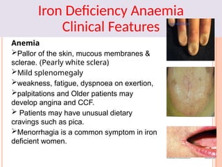 IRON DEFICIENCY ANAEMIA, P/S, S/S, DIAGNOSIS, TREATMENT | PPTX