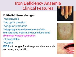 IRON DEFICIENCY ANAEMIA, P/S, S/S, DIAGNOSIS, TREATMENT | PPTX