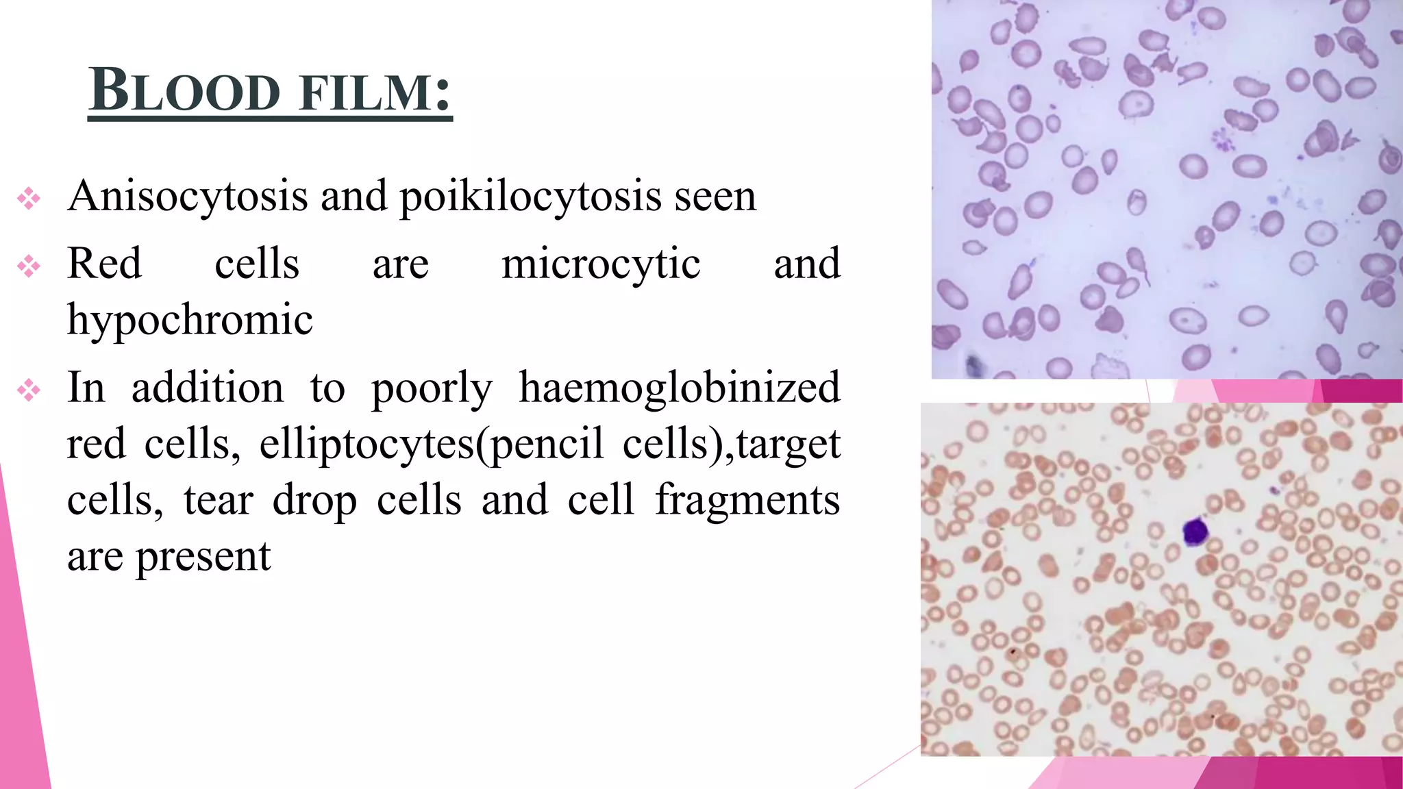 Iron Deficiency Anaemia | PPTX