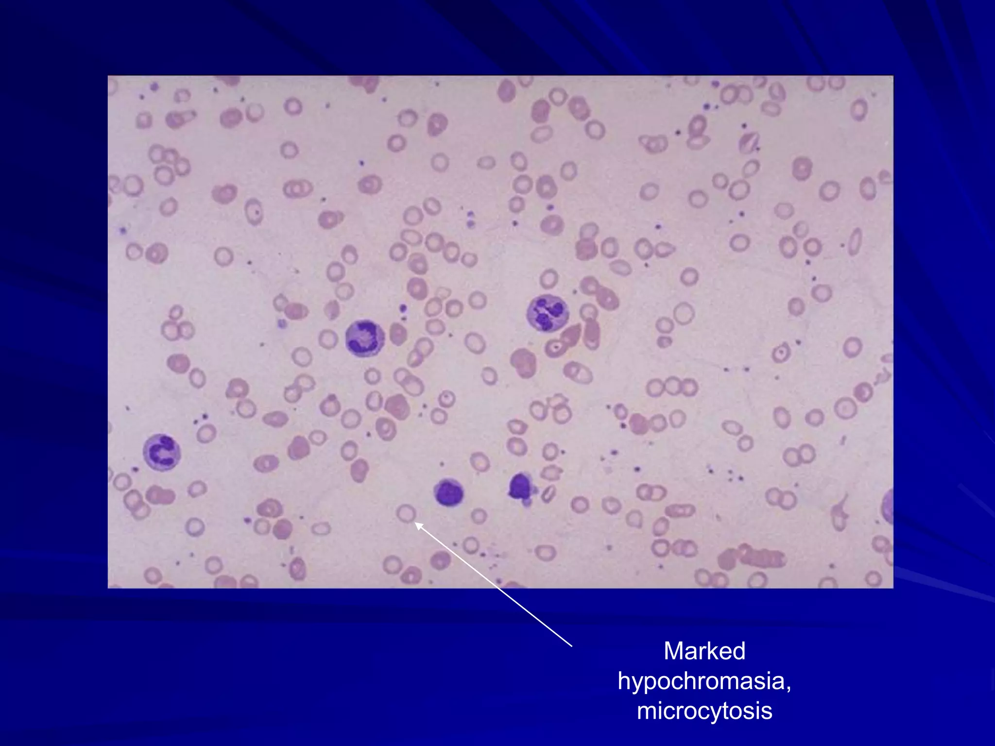 Iron deficiency anaemia 2018 | PPTX