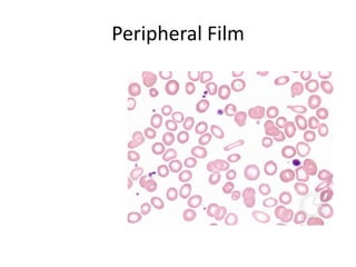 Iron deficiency anemia | PPT