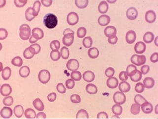 Iron Deficiency Anemia Under Microscope