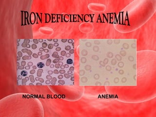 Iron deficiency anemia | PPT | Blood Disorders | Diseases and Conditions